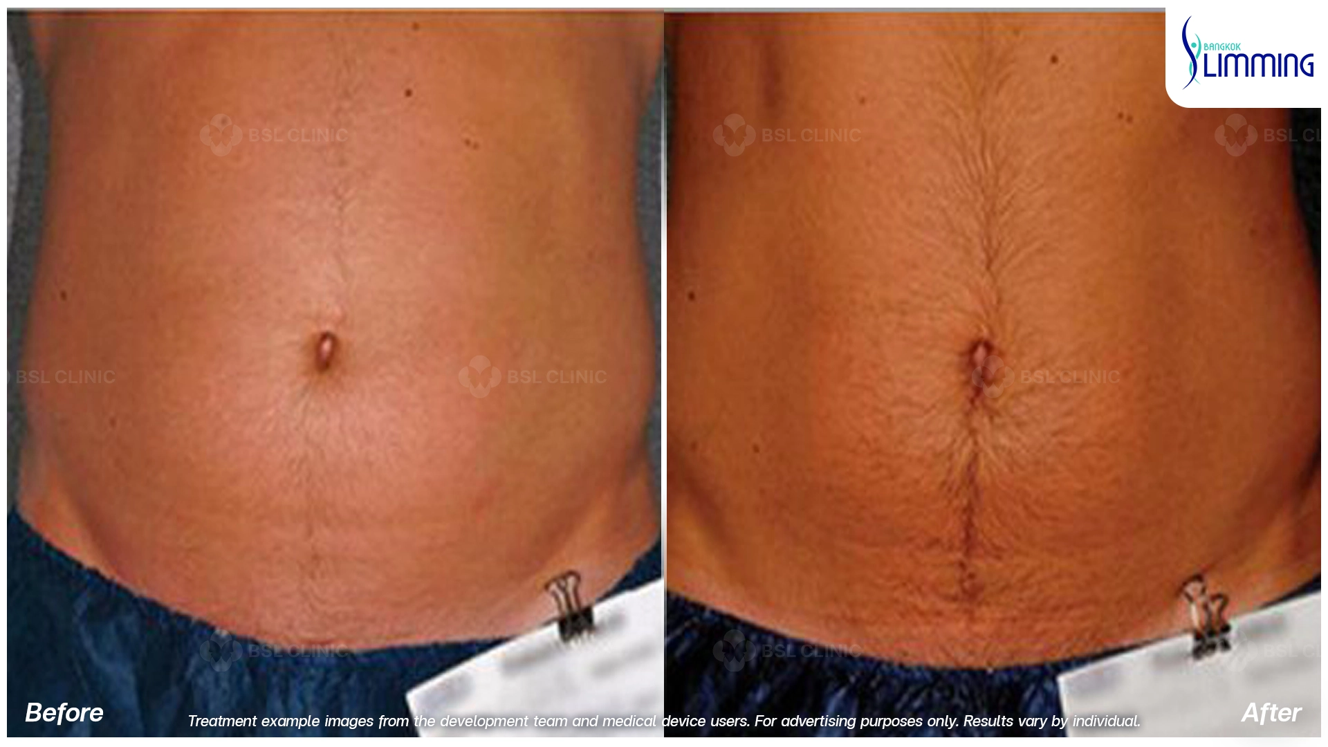 Achive a More Defined Waistline: Effective Body Contouring