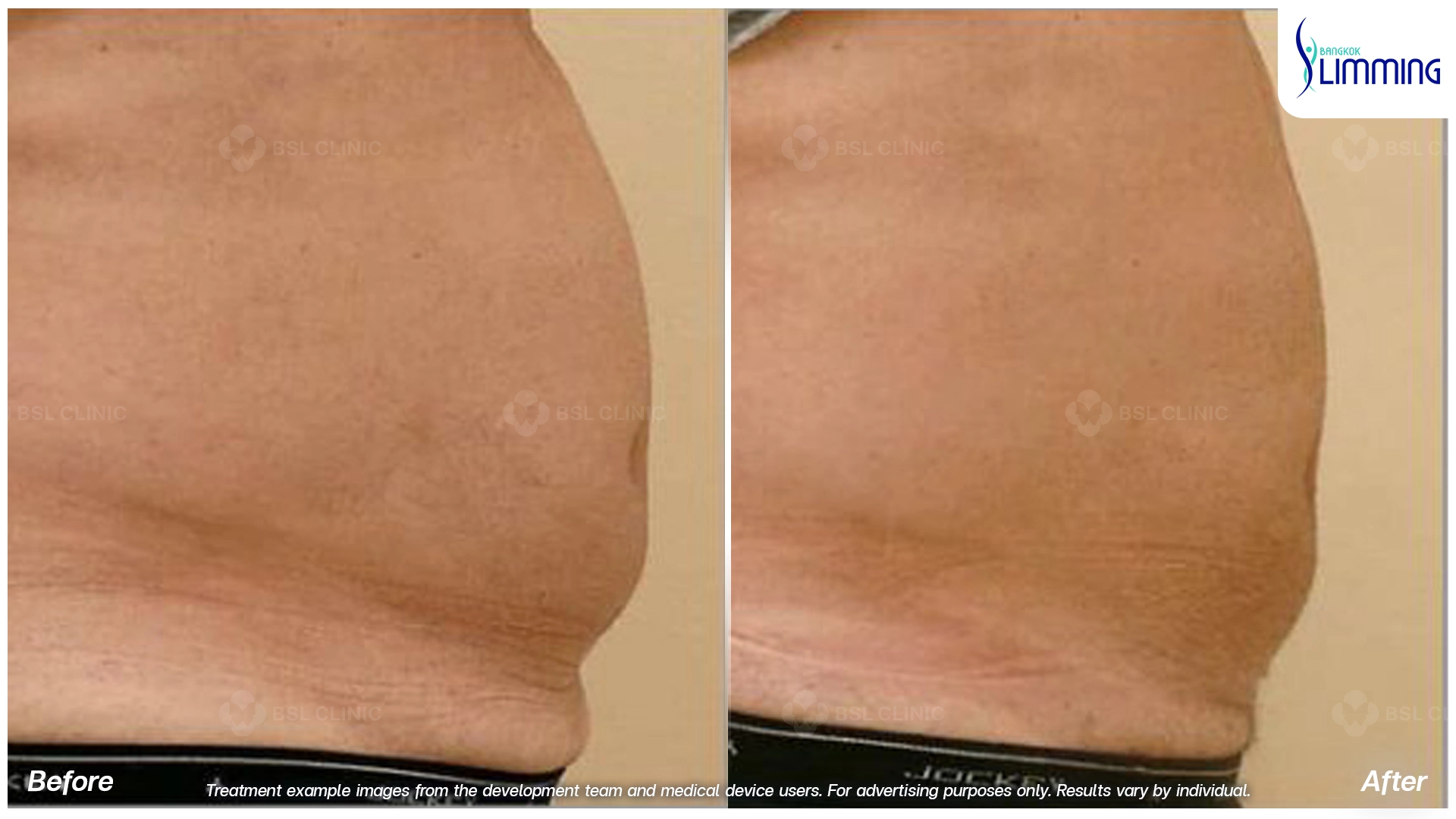 Achive a More Defined Waistline: Effective Body Contouring