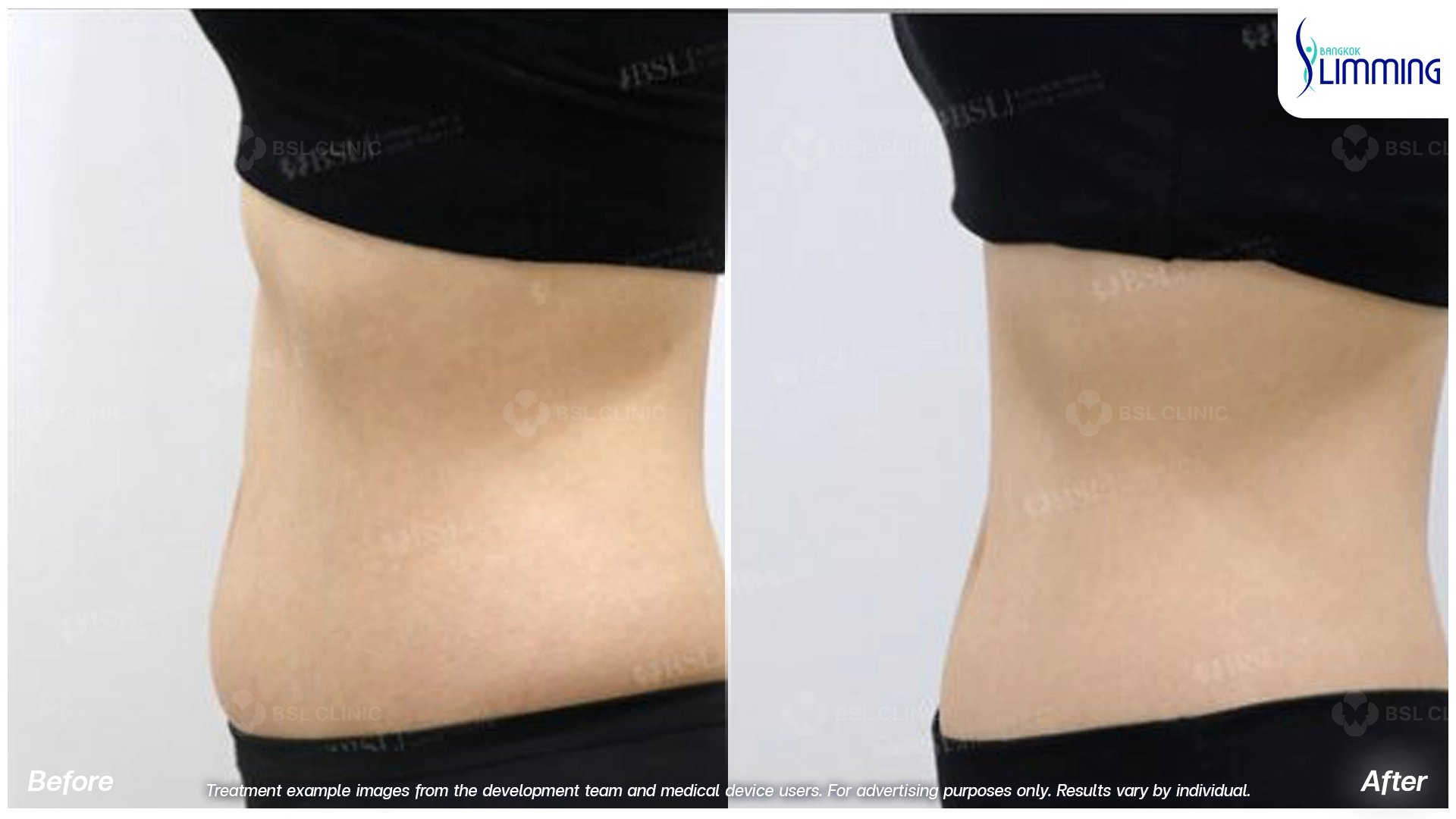 Achive a More Defined Waistline: Effective Body Contouring